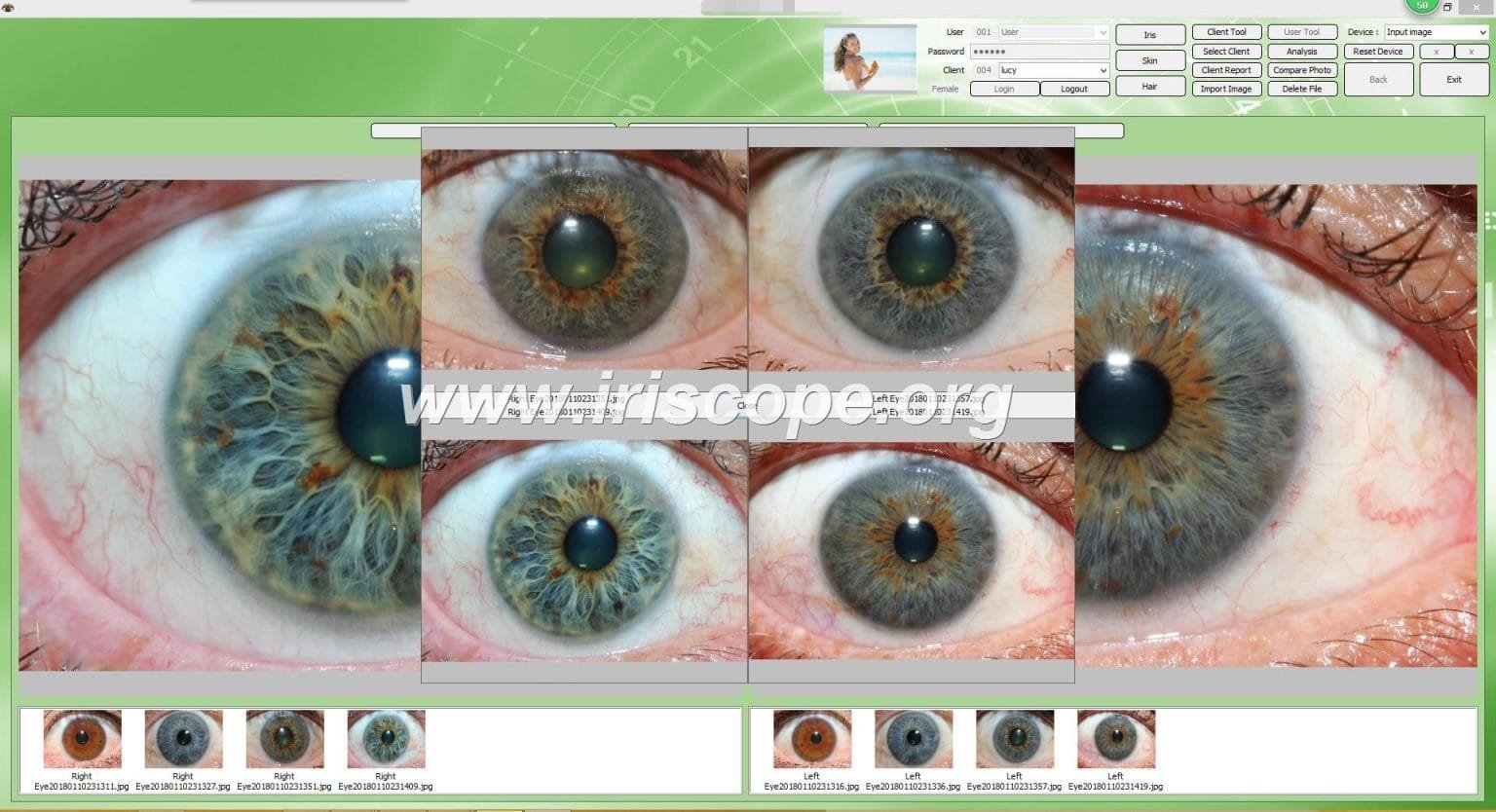 Iridology: What Does a Black Ring Around the Iris Mean?
